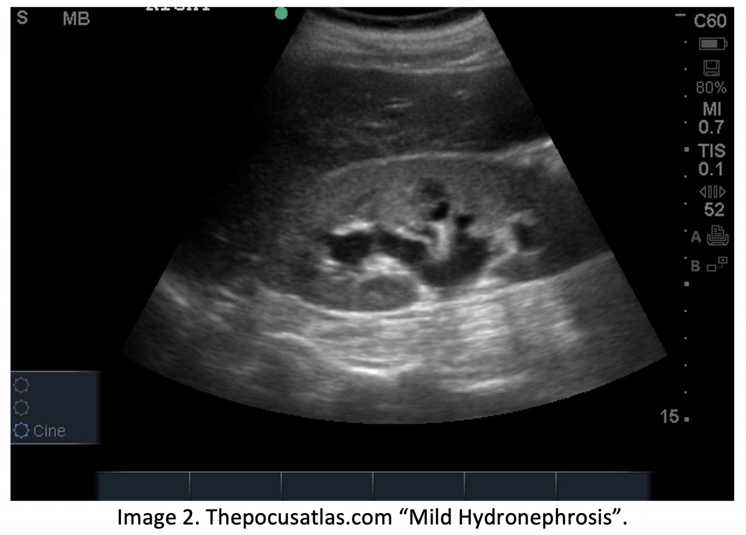 Obstructive Uropathy: Presentation, Evaluation, and Management - emDocs