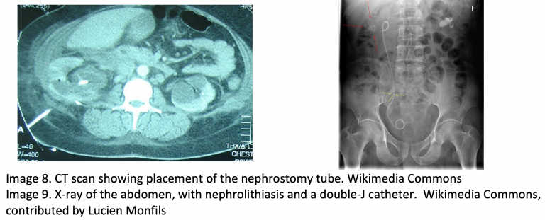 Obstructive Uropathy: Presentation, Evaluation, and Management - emDocs