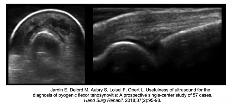 The Evaluation and Management of Hand Infections in the Emergency ...