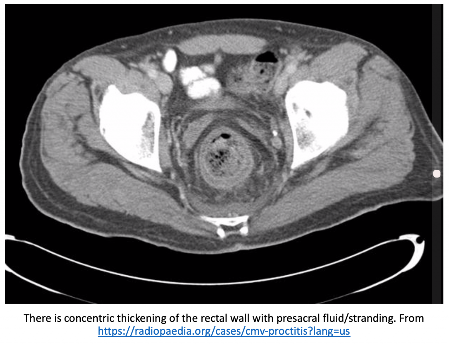 emDOCs.net – Emergency Medicine EducationEM@3AM: Proctitis - emDOCs.net ...