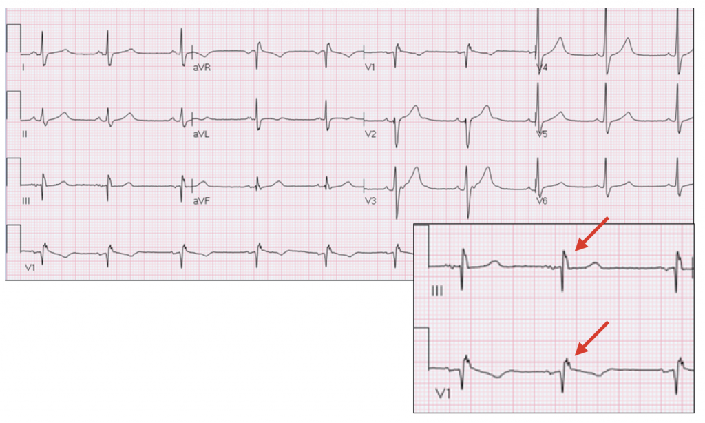 ECG Pointers: Myocarditis and QRS fragmentation - emDocs