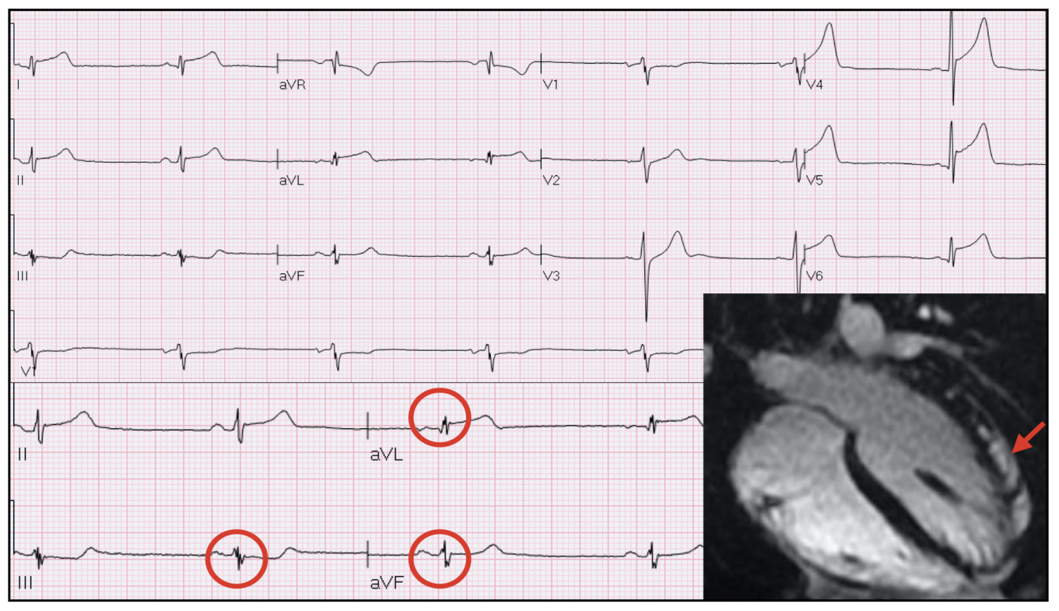 ECG Pointers: Myocarditis and QRS fragmentation - emDocs