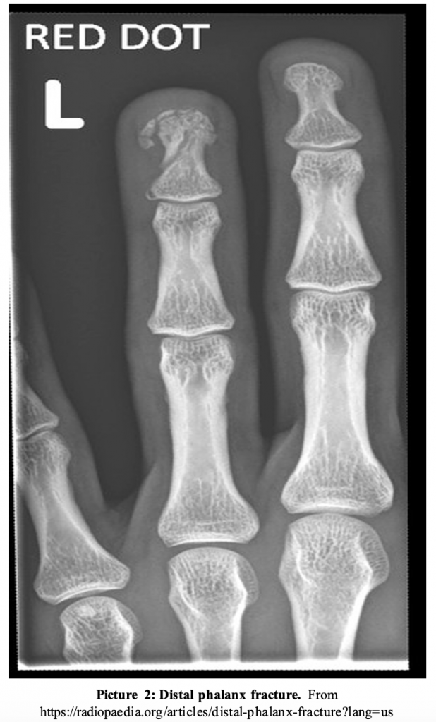 Evidence-based Approach to Nailbed Injuries: ED Presentations ...