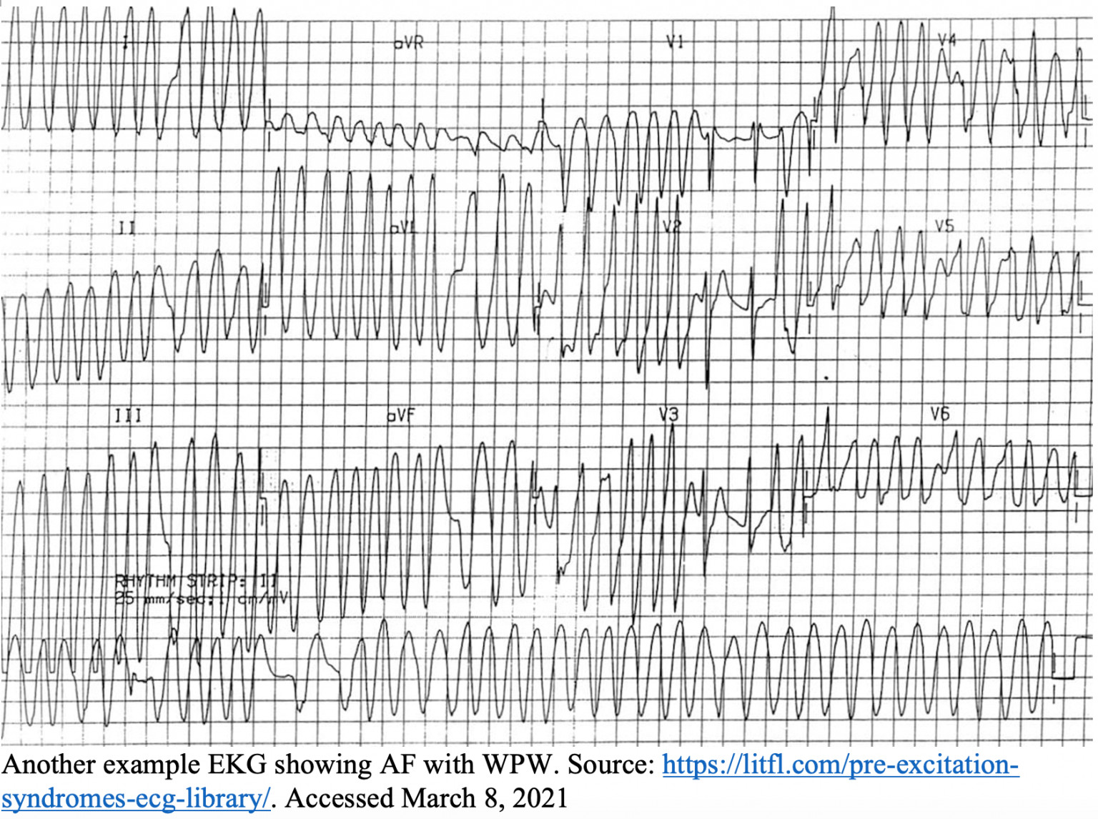 Electrical cardioversion in the ED: who crashes and how to improve - emDocs