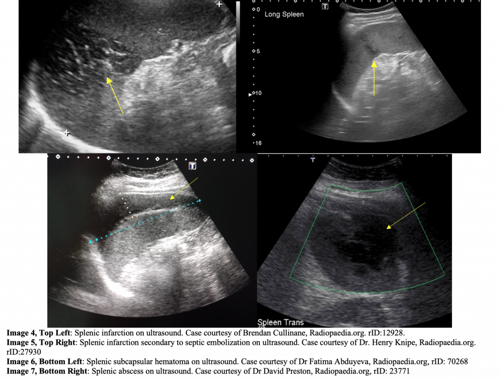 Splenic Infarction: ED Presentation, Evaluation, and Management - emDocs