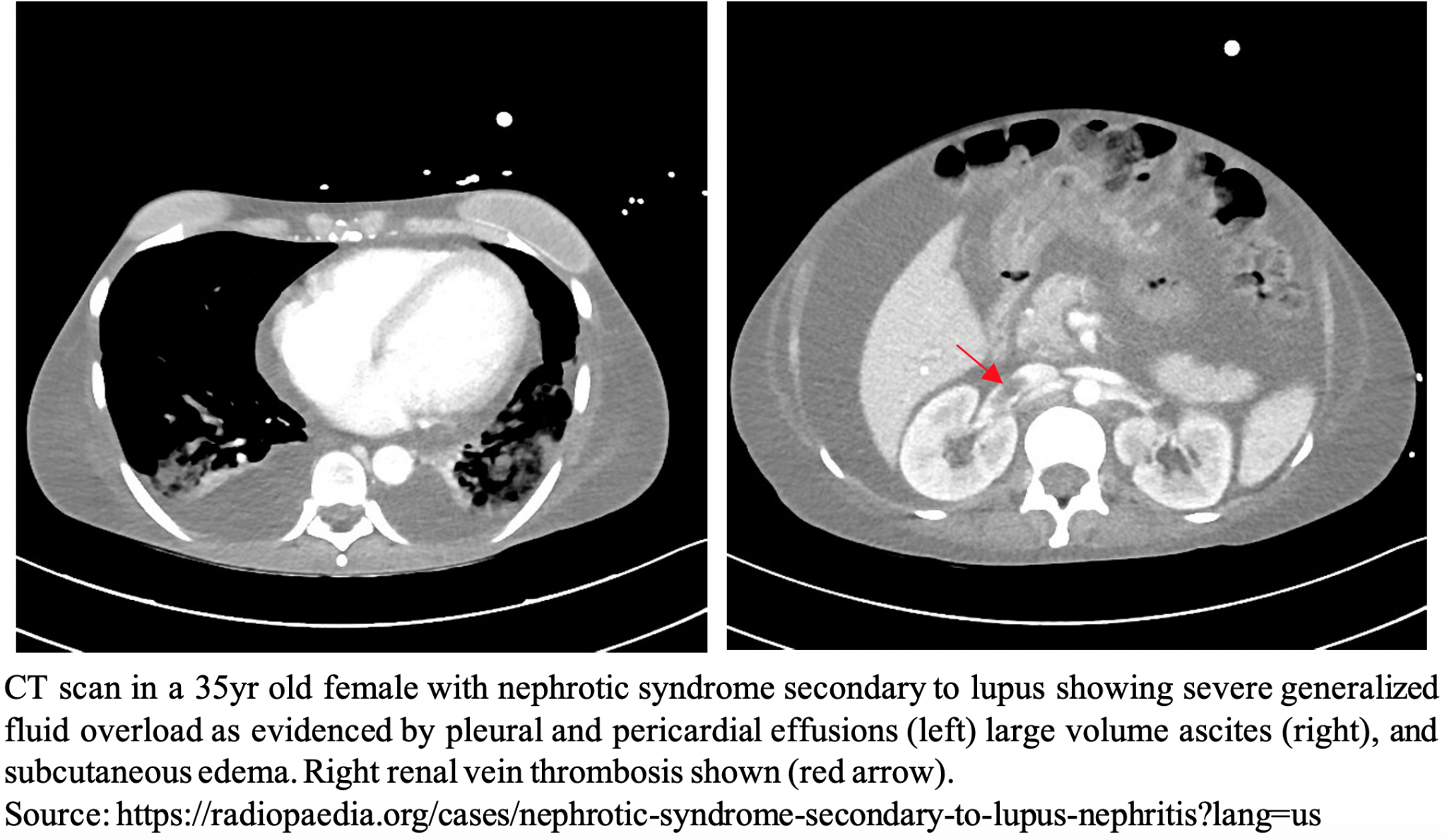 EM@3AM: Nephrotic Syndrome - emDocs