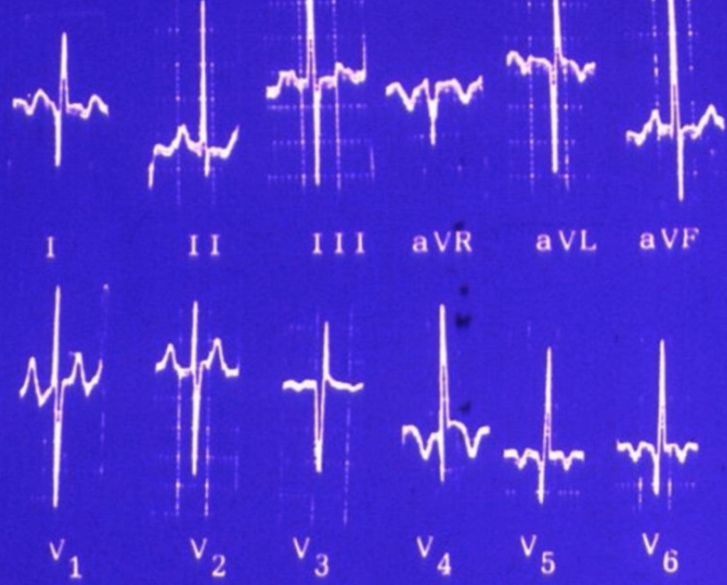 ECG Pointers: Anomalous Left Coronary Artery from the Pulmonary Artery ...