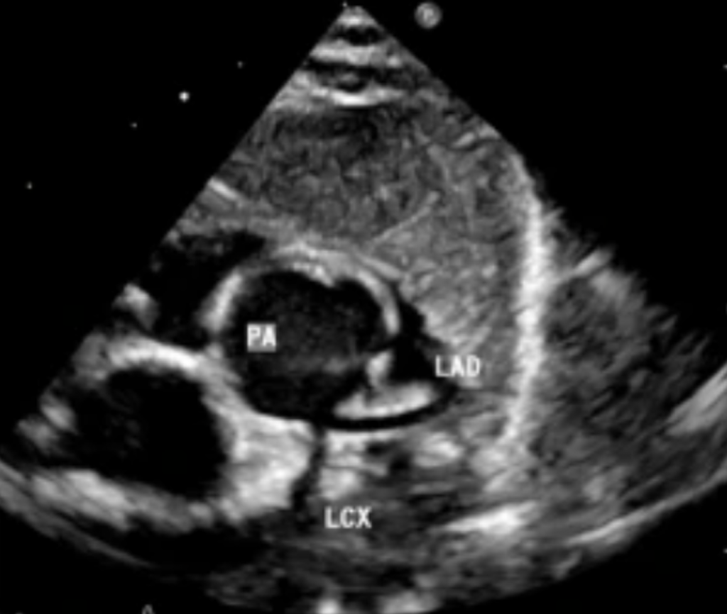 ECG Pointers: Anomalous Left Coronary Artery from the Pulmonary Artery ...