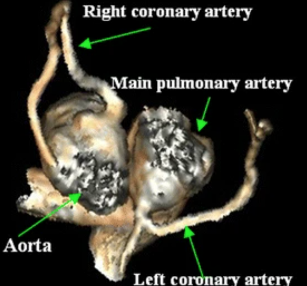 ECG Pointers: Anomalous Left Coronary Artery from the Pulmonary Artery ...