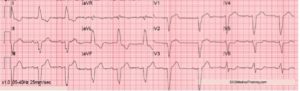 ECG pointers: The Barcelona Criteria - emDocs
