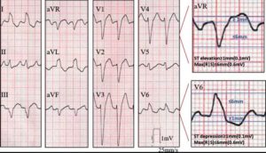 ECG pointers: The Barcelona Criteria - emDocs