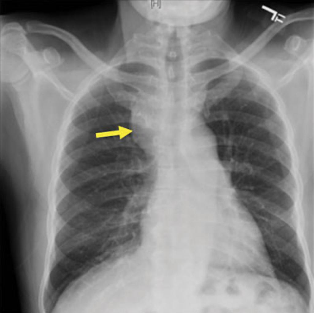Medical Malpractice Insights: Chest pain, a widened mediastinum, and a ...
