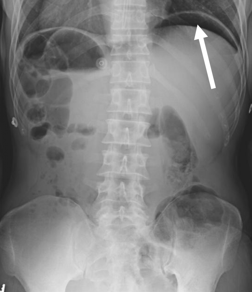 Bowel Perforation: ED presentations, evaluation, and management - emDocs