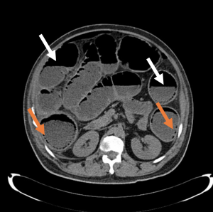 Bowel Perforation: ED presentations, evaluation, and management - emDocs