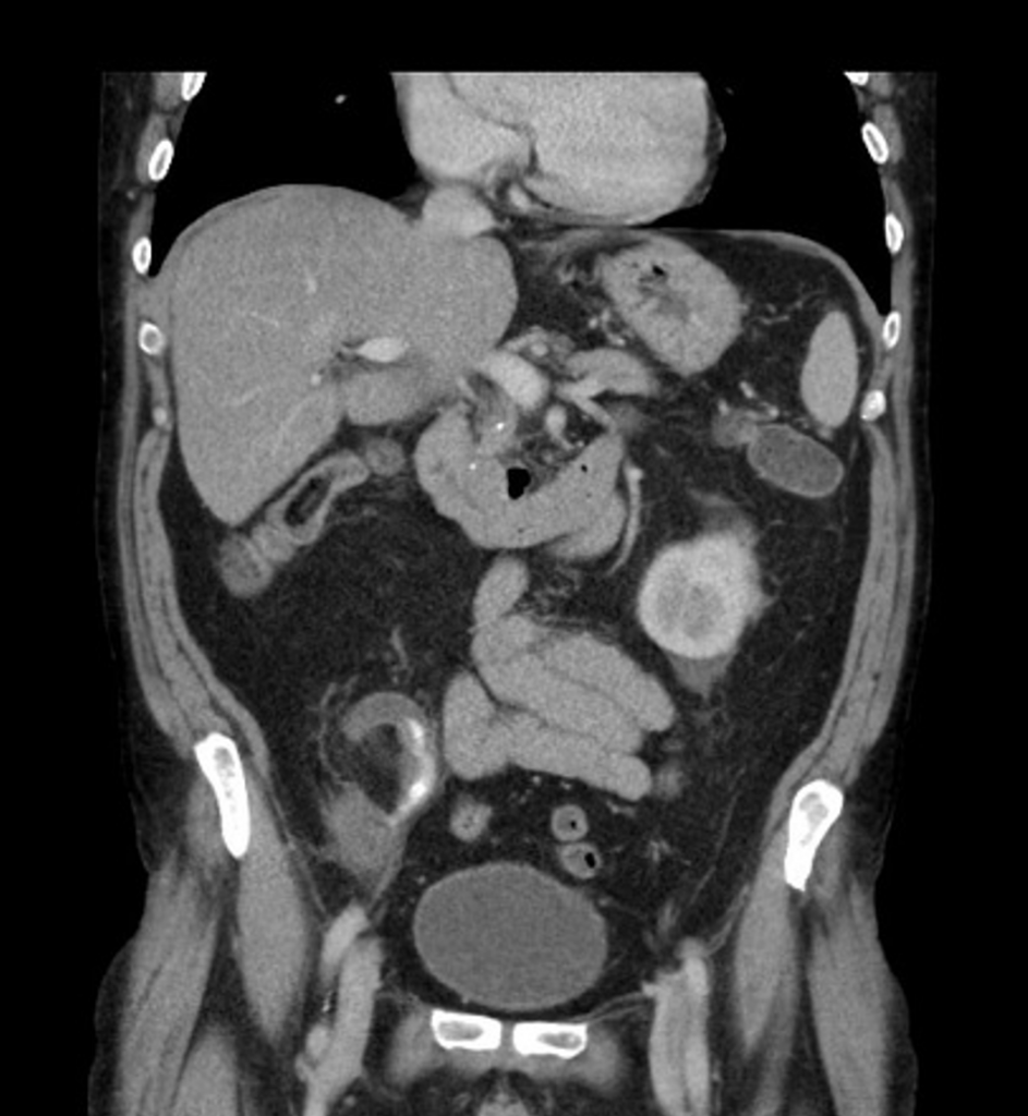 Pediatric Small Talk - The Rule of 6: Pediatric Abdominal Surgical ...