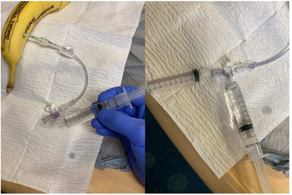 An effective technique for aspiration in ischemic priapism: The ...
