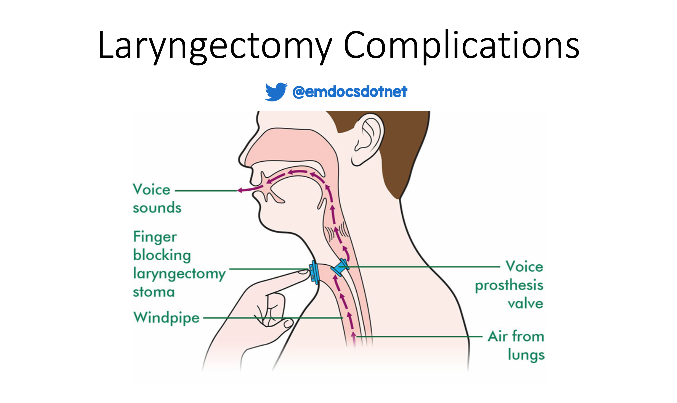 Laryngectomy Vs Tracheostomy Laryngectomy Vs Tracheostomy