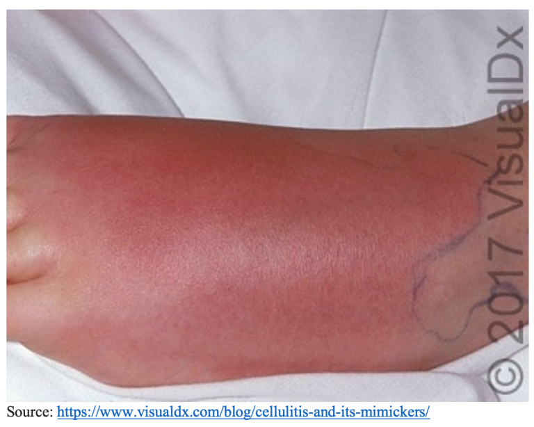 emDOCs Podcast - Episode 59: Cellulitis - emDocs