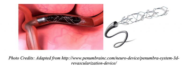 Diagnosis and Neurointerventional Management of Large Vessel Occlusion ...
