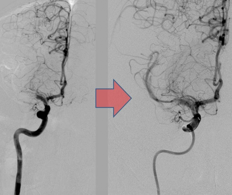 Diagnosis and Neurointerventional Management of Large Vessel Occlusion ...