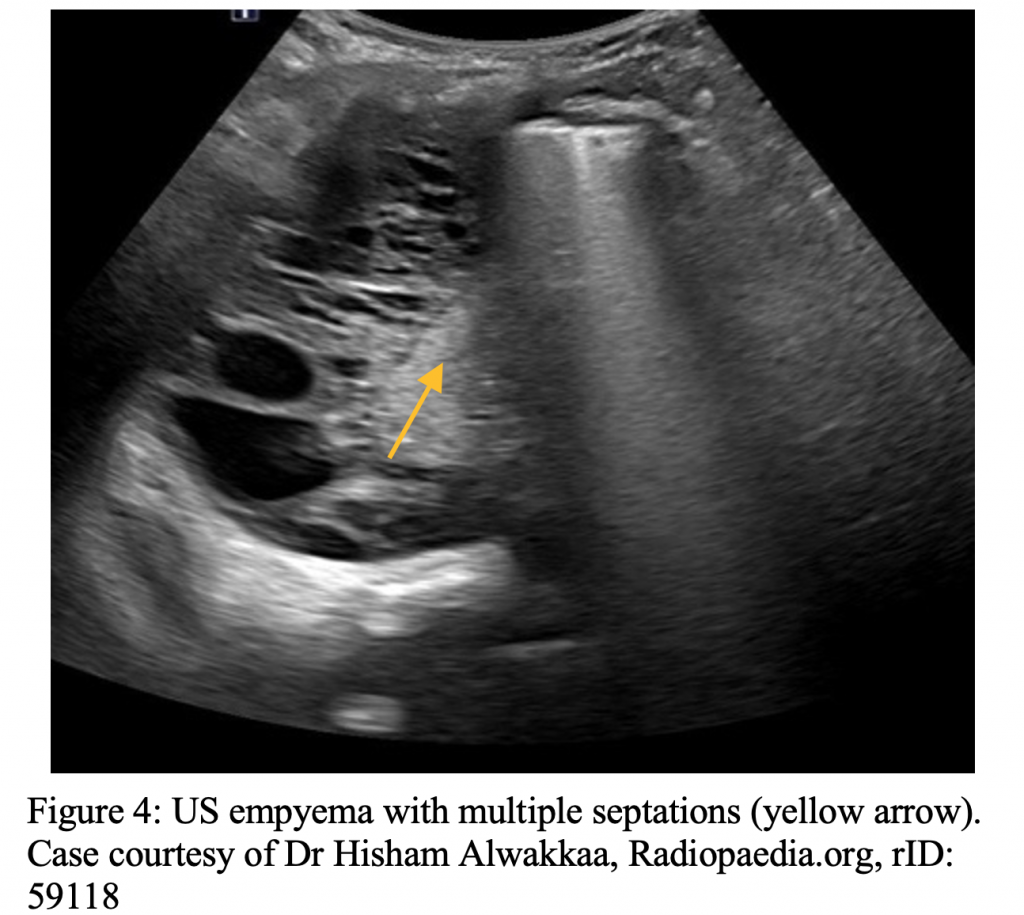 Empyema: ED Presentation, Evaluation, and Management - emDocs