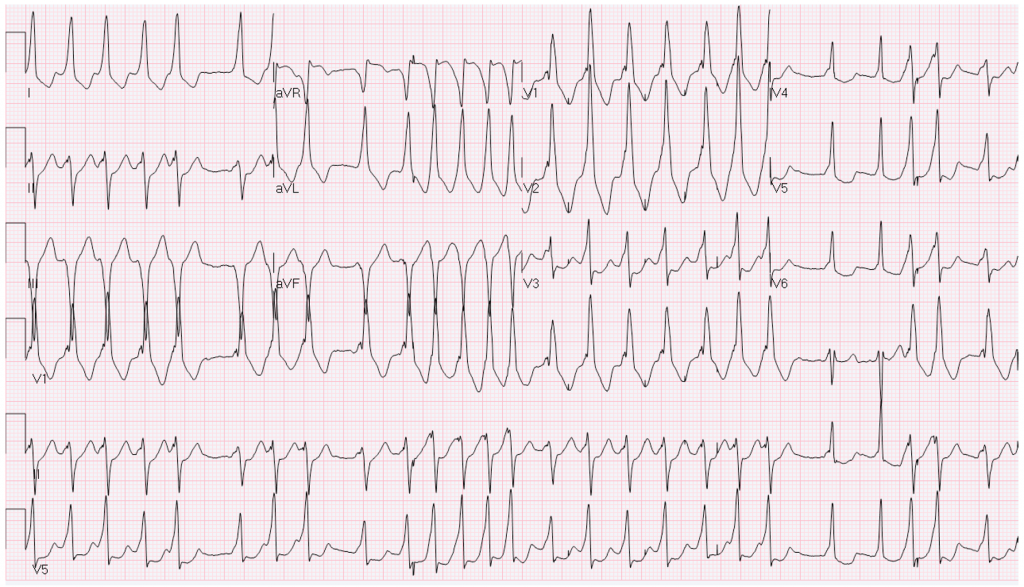ECG Pointers: Atrial Fibrillation with Aberrancy - emDocs