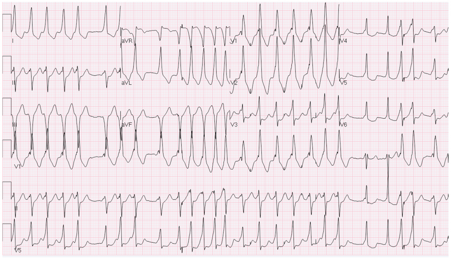 ECG Pointers: Atrial Fibrillation with Aberrancy - emDocs