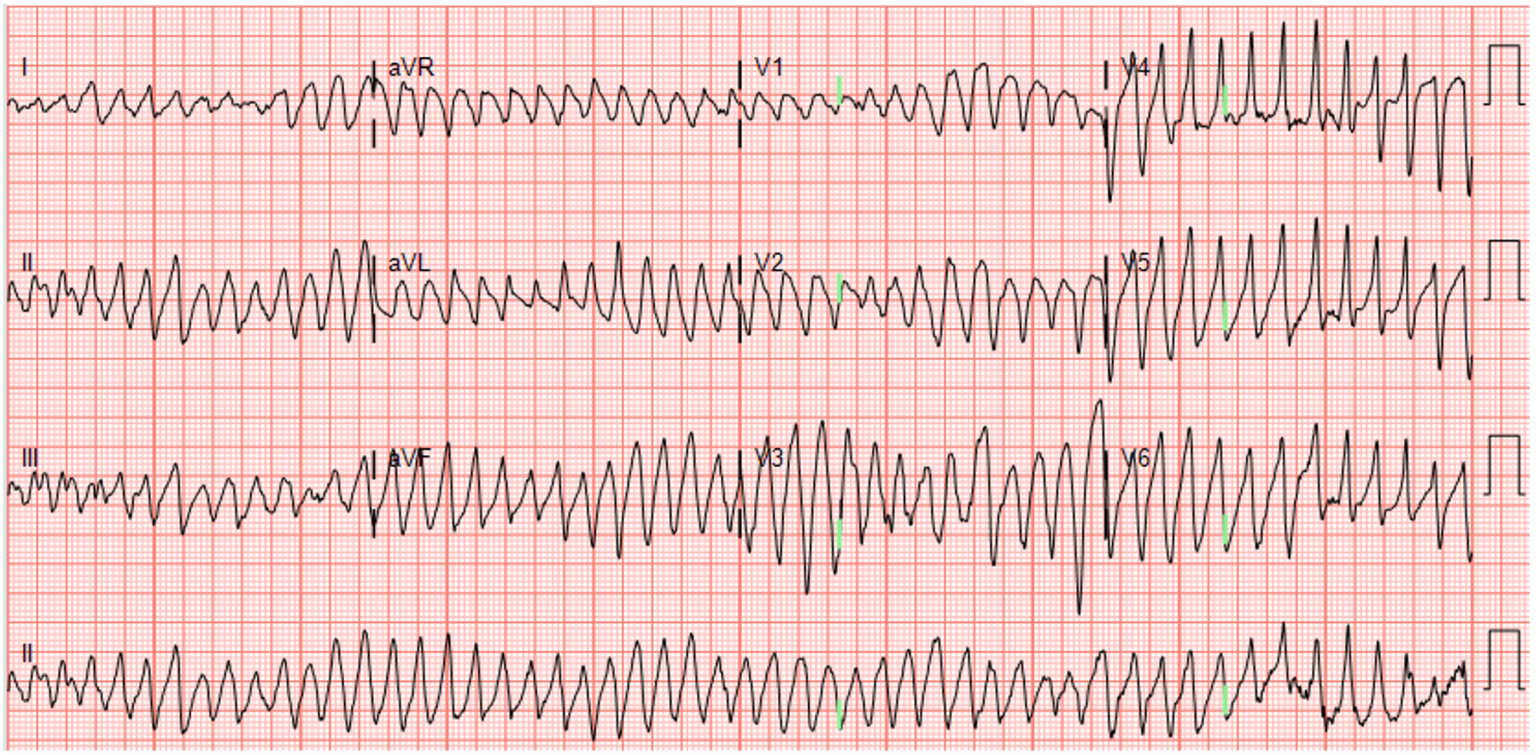 ECG Pointers: Atrial Fibrillation with Aberrancy - emDocs