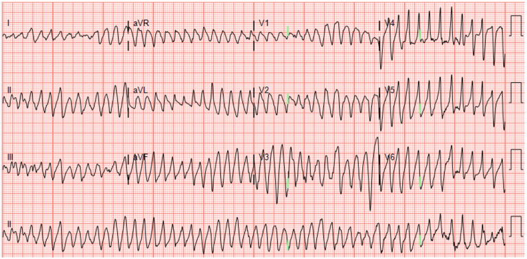 ECG Pointers: Atrial Fibrillation with Aberrancy - emDocs