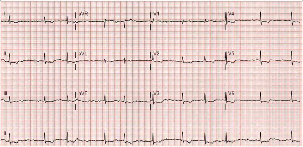 ECG Pointers: Atrial Fibrillation with Aberrancy - emDocs