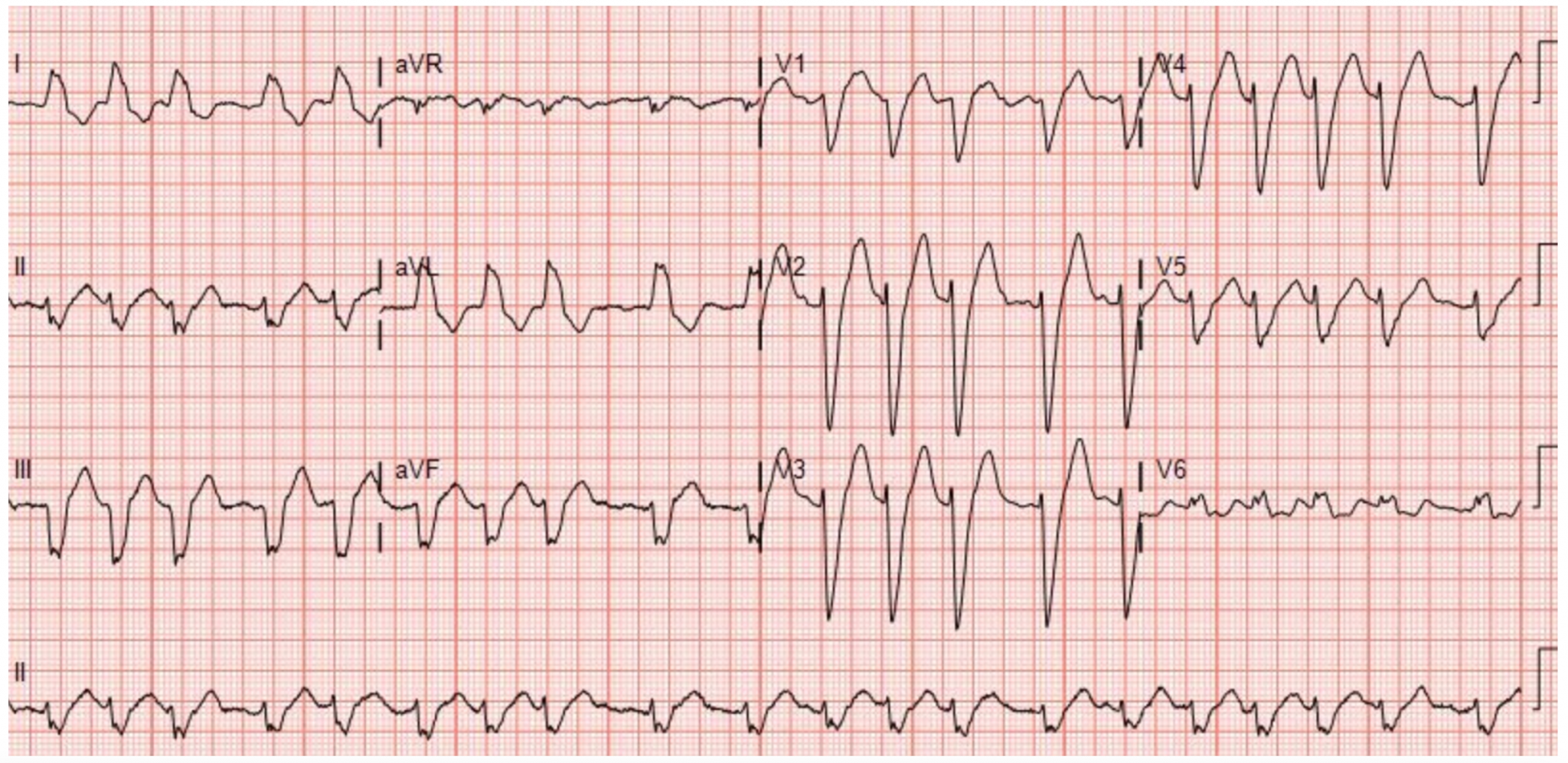ECG Pointers: Atrial Fibrillation with Aberrancy - emDocs