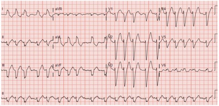 ECG Pointers: Atrial Fibrillation with Aberrancy - emDocs