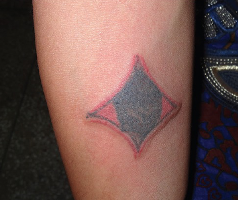 Tattoo-related Complications in the Emergency Department - emDocs