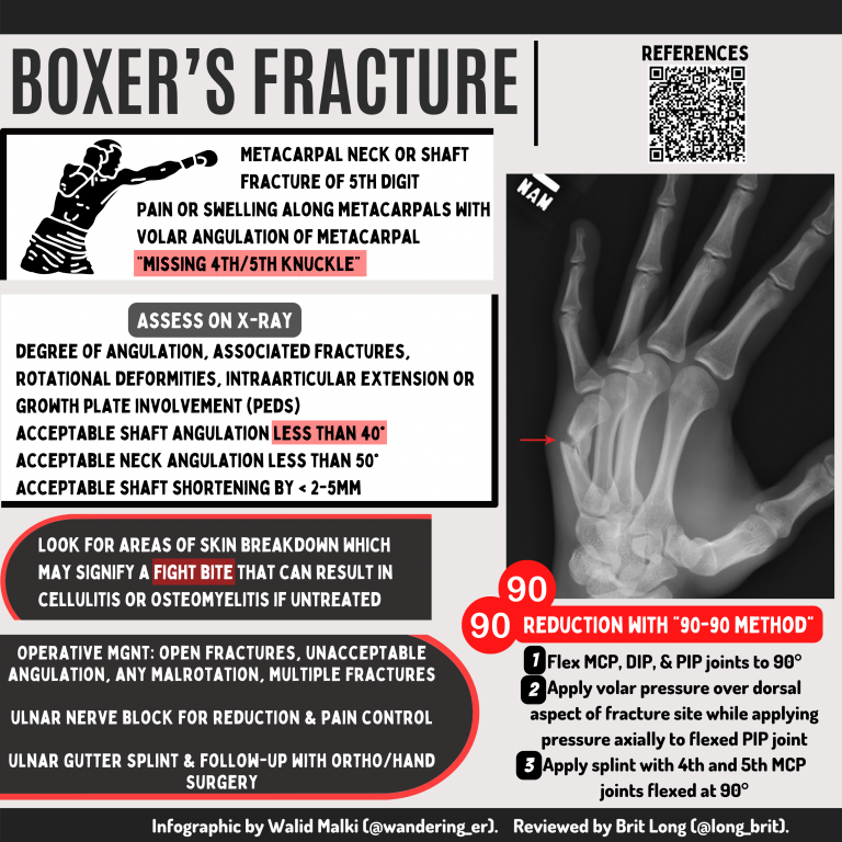 Visual Wednesdays: Boxer's Fracture - emDocs