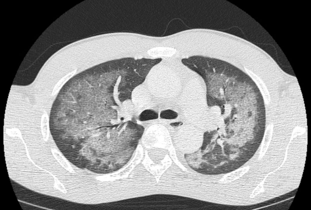 EM@3AM: Crack Lung - emDocs