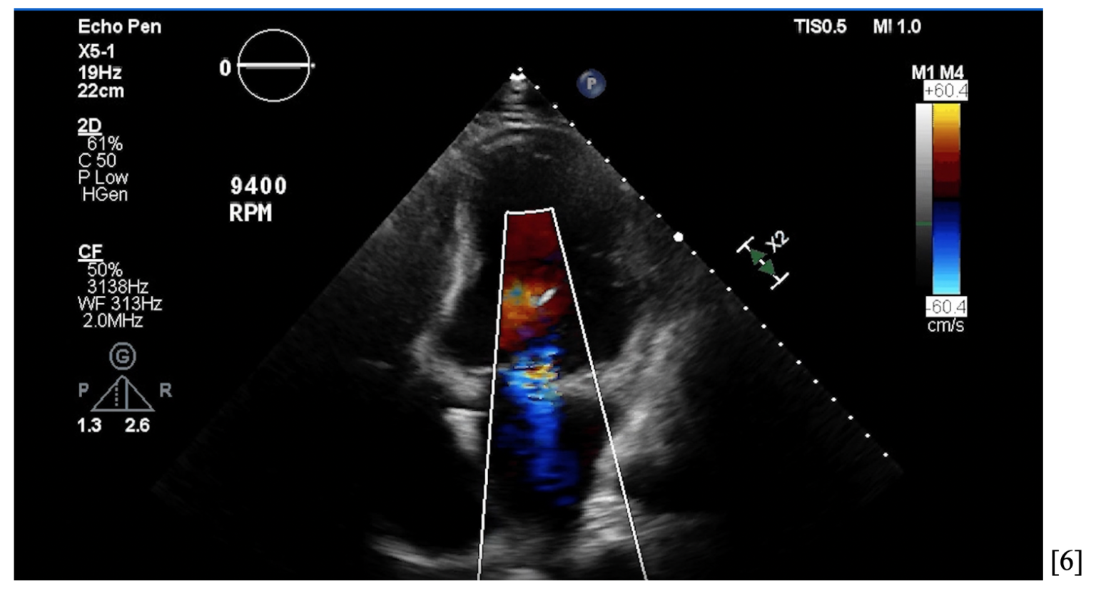 EM@3AM: Mitral Regurgitation - emDocs