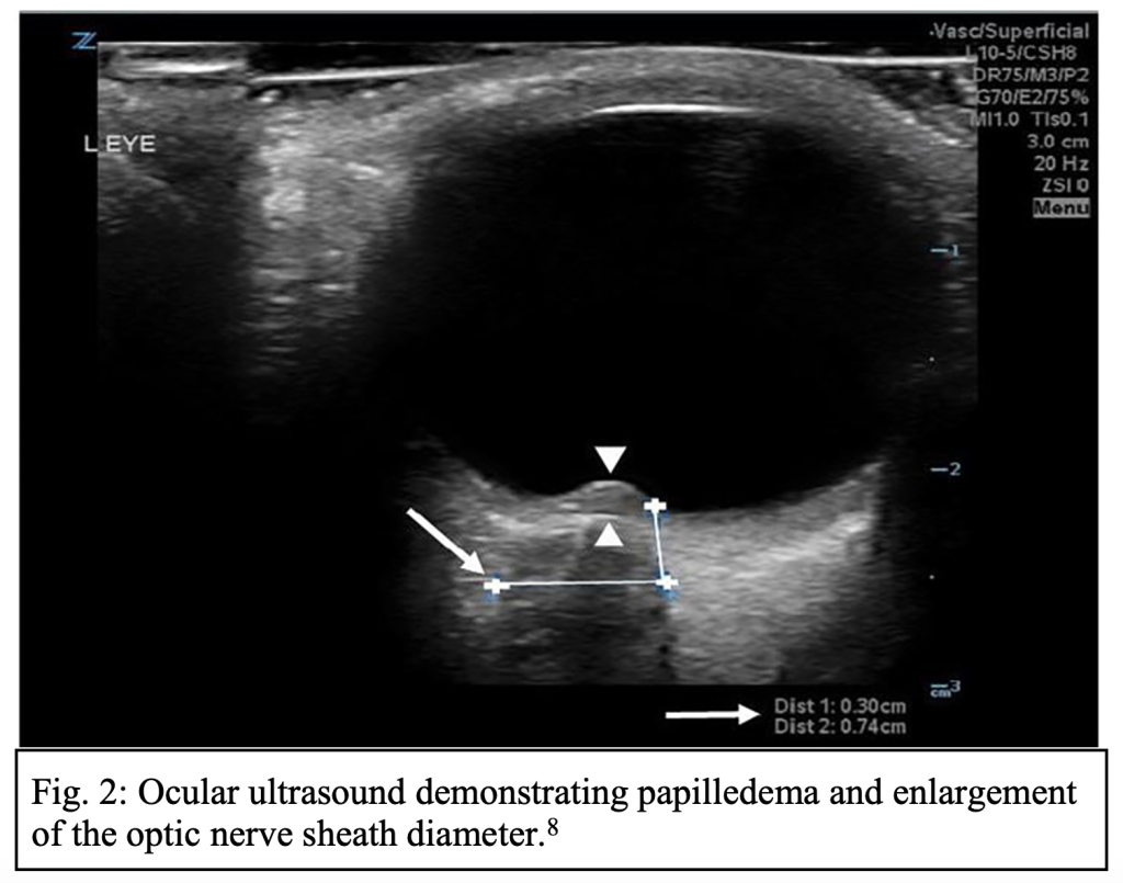 Optic Neuritis: ED Evaluation and Management - emDocs