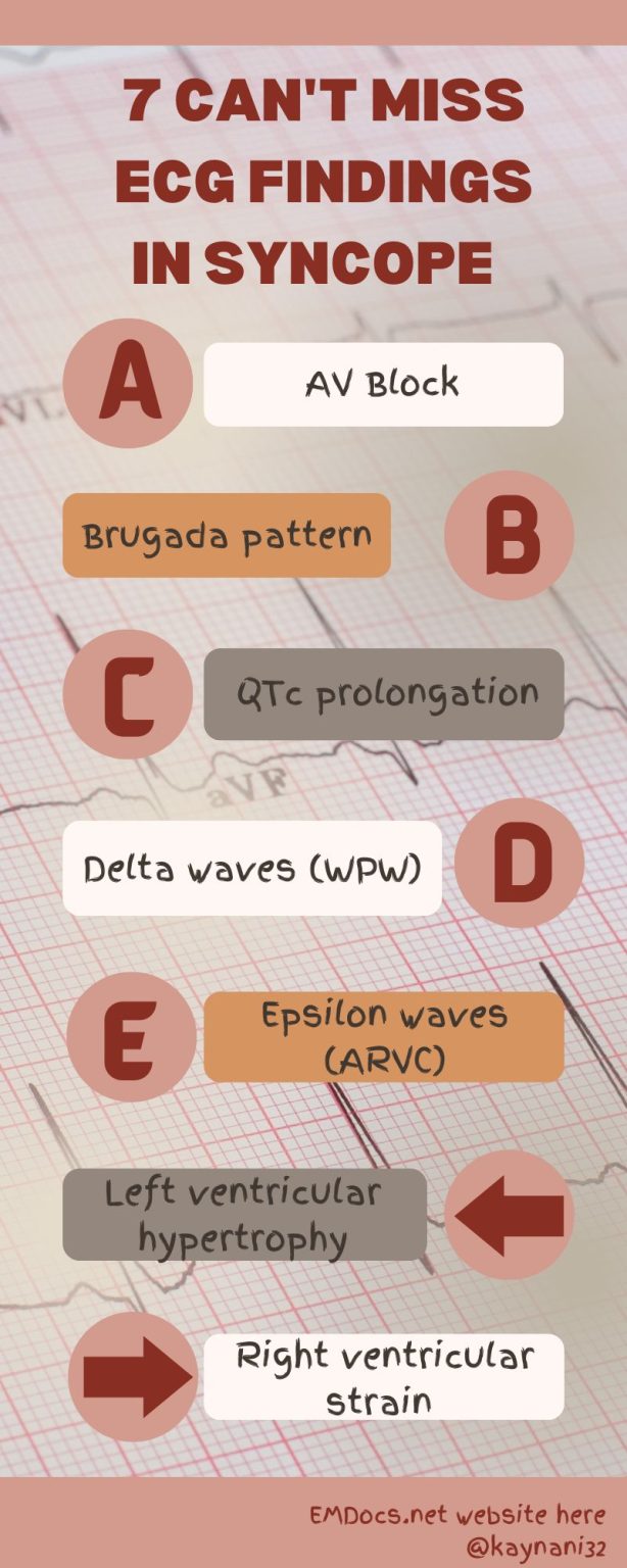 ECG Pointers: 7 Can’t-Miss ECG Patterns of High-Risk Syncope - the ...