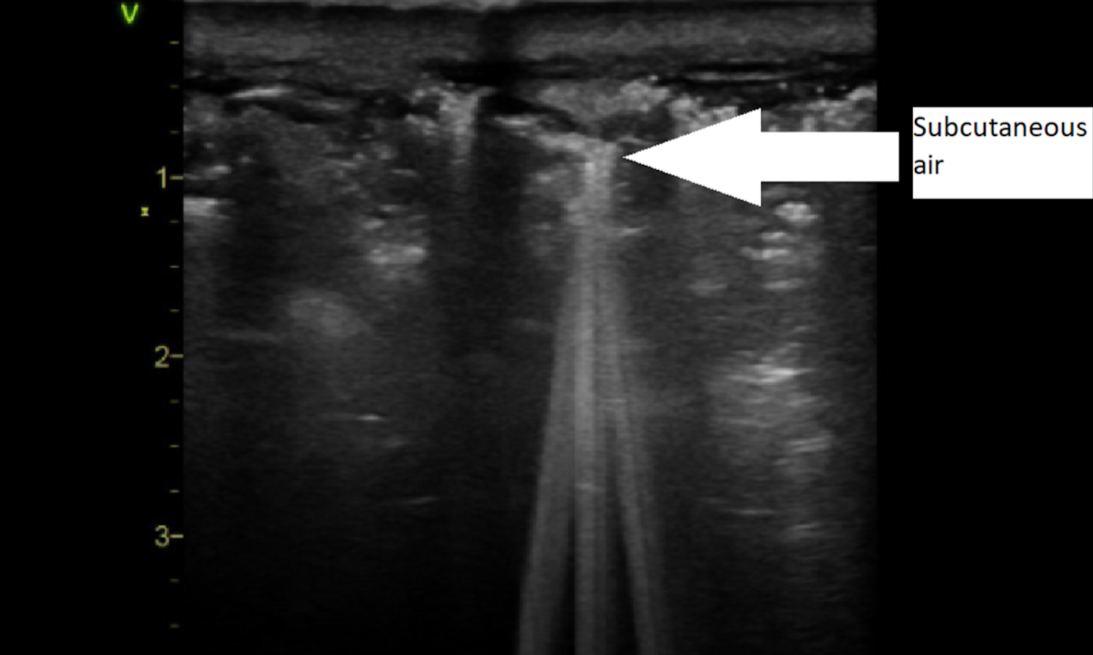 emDOCs Podcast - Episode 66: NSTI Pearls and Pitfalls Part II - emDocs
