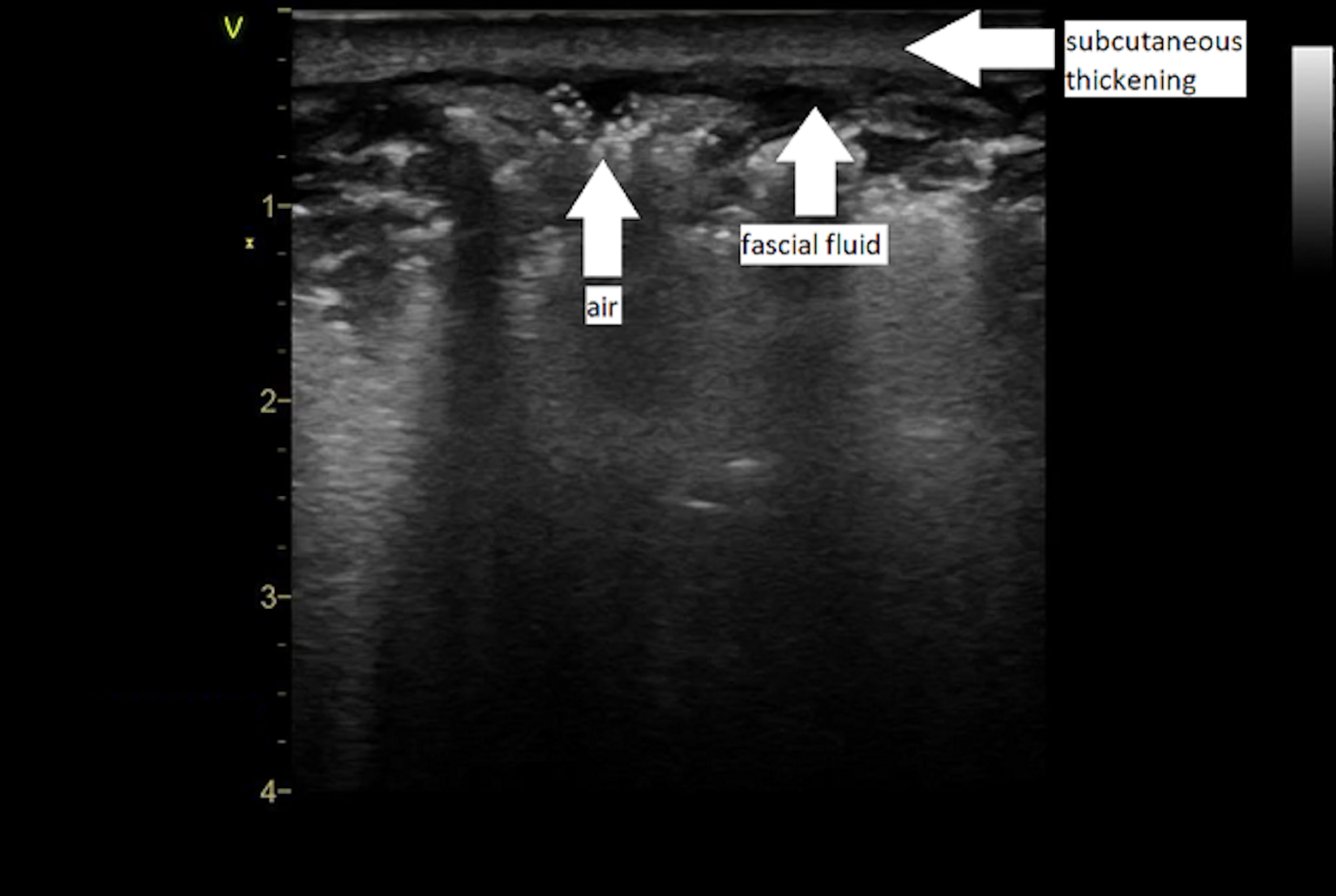 emDOCs Podcast - Episode 66: NSTI Pearls and Pitfalls Part II - emDocs