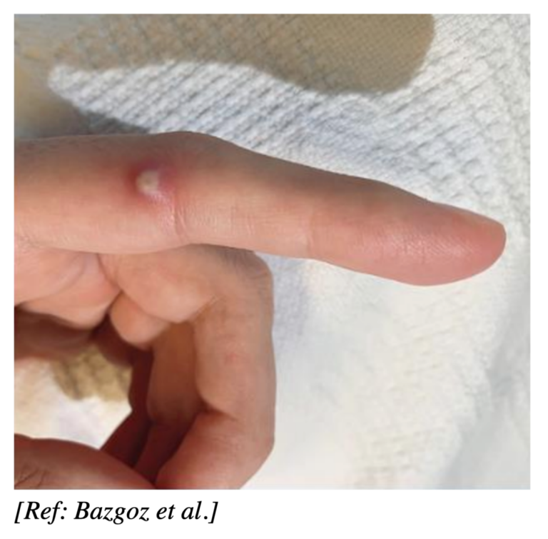 EM@3AM: Monkeypox - emDocs