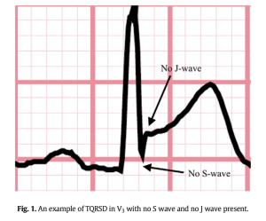 52 in 52 - #15: Terminal QRS distortion is present in anterior ...