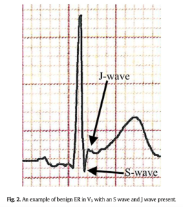 52 in 52 - #15: Terminal QRS distortion is present in anterior ...