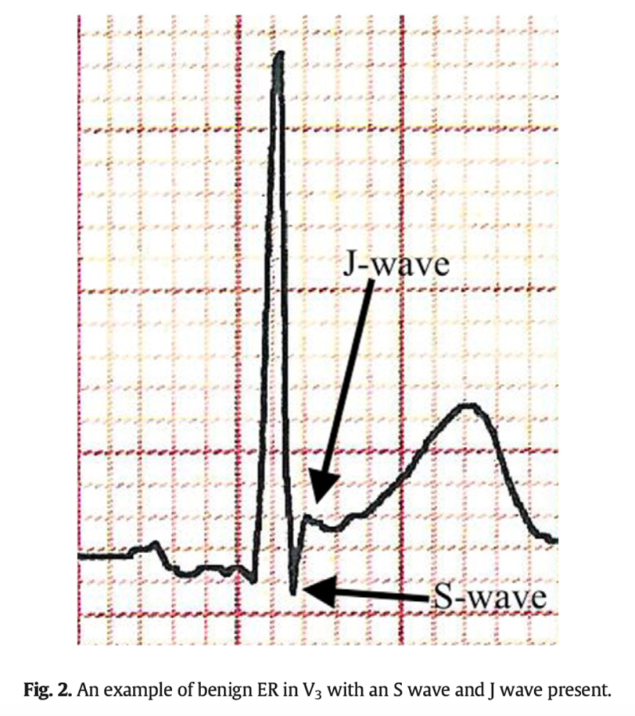 52 in 52 - #15: Terminal QRS distortion is present in anterior ...
