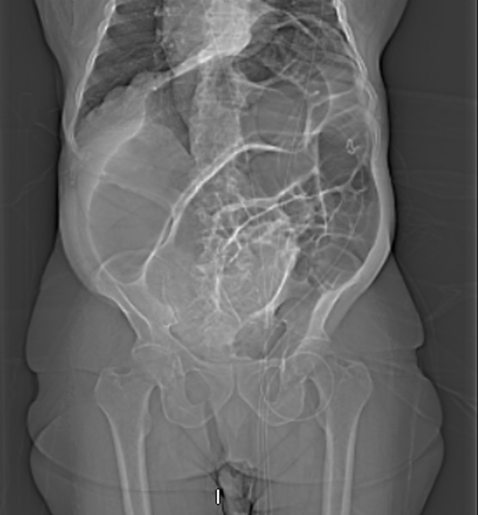 EM@3AM: Sigmoid Volvulus - emDocs