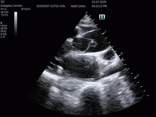 emDOCs.net – Emergency Medicine EducationVid 1 Aortic root intimal ...