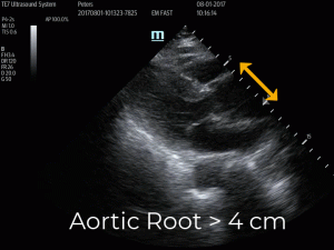 emDOCs.net – Emergency Medicine EducationVid 2 Dilated Aortic Root no ...