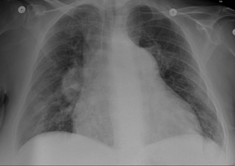 Right Heart Failure in the ED: Approach to Diagnosis and Management - emDocs
