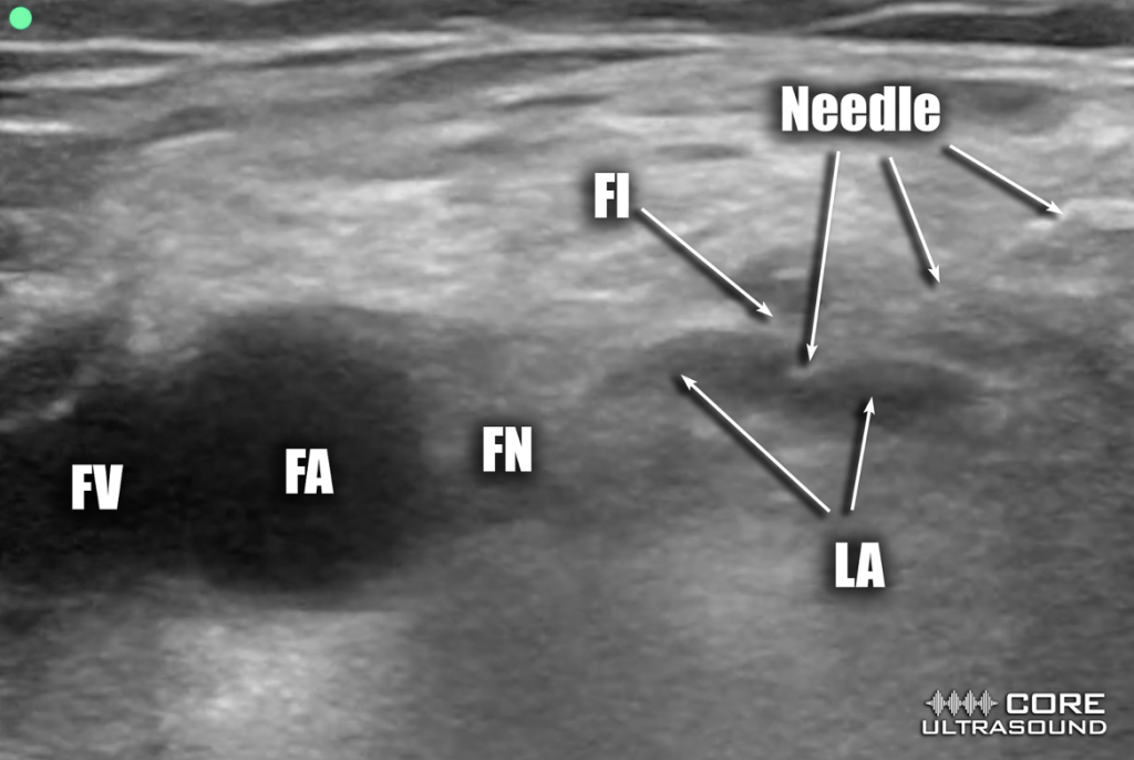 Ultrasound-Guided Regional Anesthesia for Hip Fractures - emDocs