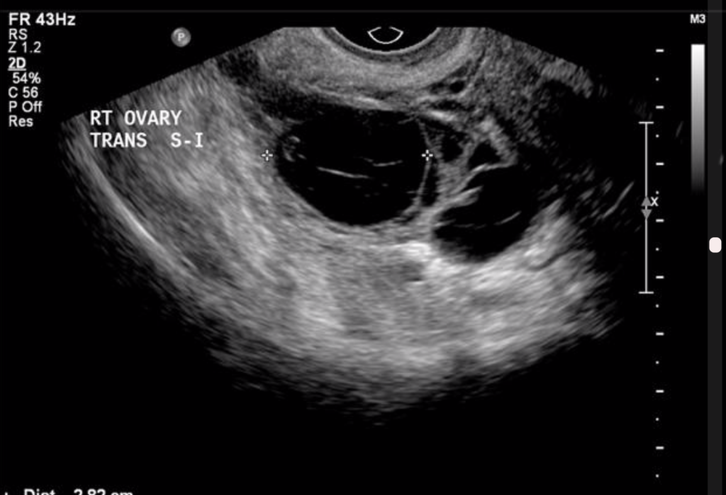 emDOCs Podcast - Episode 68: Tubo-Ovarian Abscess - emDocs